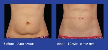 Cryo Sculpting – Polished Spa