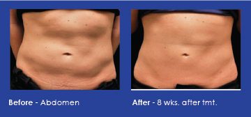 Cryo Sculpting – Polished Spa