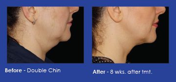 Cryo Sculpting – Polished Spa