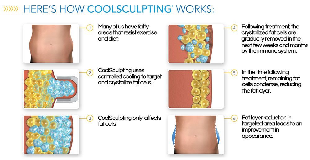 Cryo Sculpting – Polished Spa